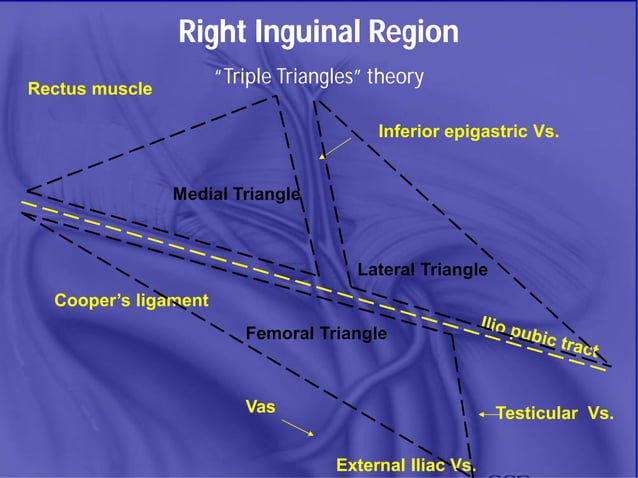 eTEP_for_Inguinal Hernias_Dr_Sanjiv_Haribhakti_www.gisurgery.info (1 ...