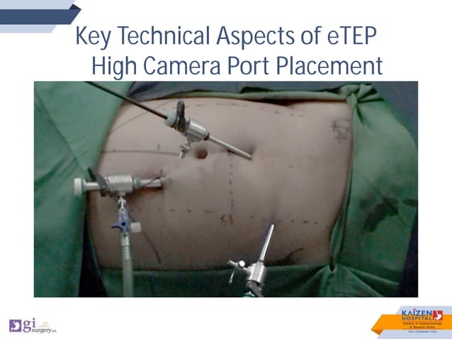 eTEP_for_Inguinal Hernias_Dr_Sanjiv_Haribhakti_www.gisurgery.info (1 ...