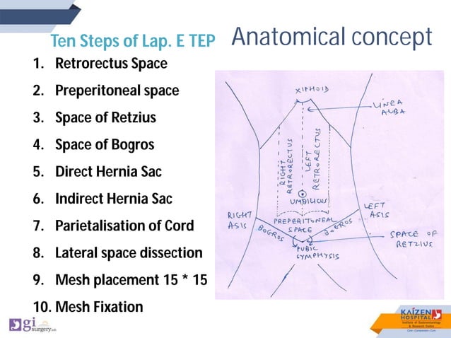 Etep For Inguinal Hernias Dr Sanjiv Haribhakti 1 Pdf