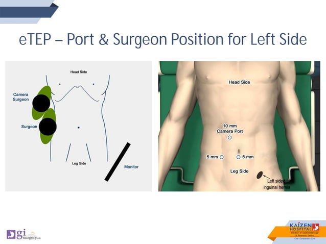 Etep For Inguinal Hernias Dr Sanjiv Haribhakti 1 Pdf