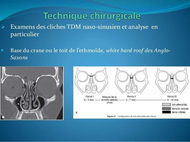 Ethmoidectomie