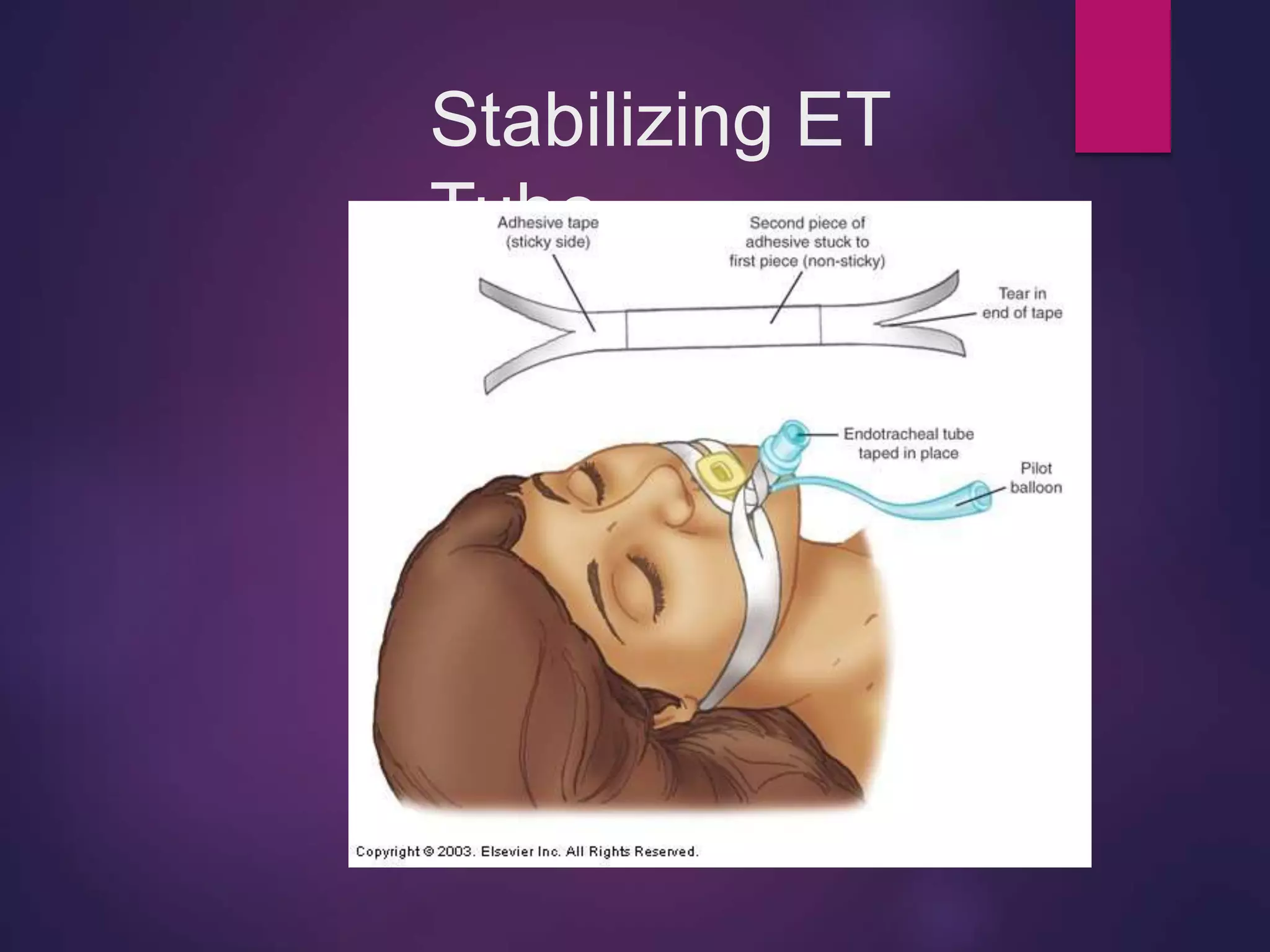 ET intubation( Endotracheal Intubation) | PPTX