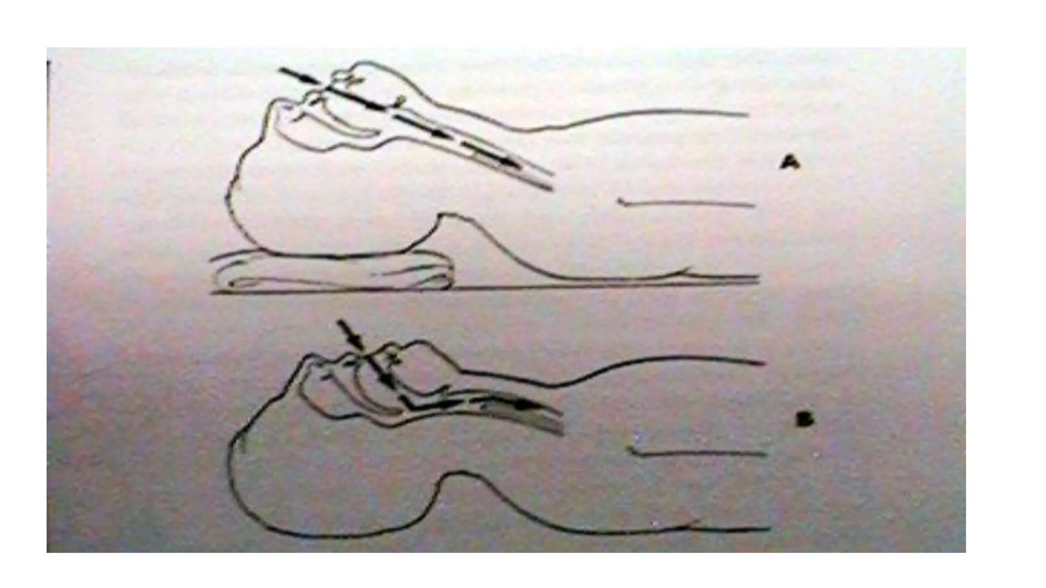 ET intubation..pptxbjjjnnkkkhhuujjehdgdjfb | PPT