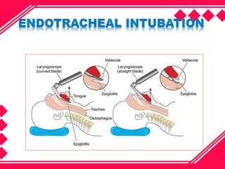 Endotracheal intubation | PPTX