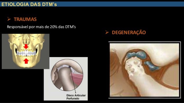 Etiologia, sinais e sintomas das DTM's