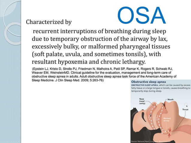 Etiology Of Obstructive sleep apnea | PPT