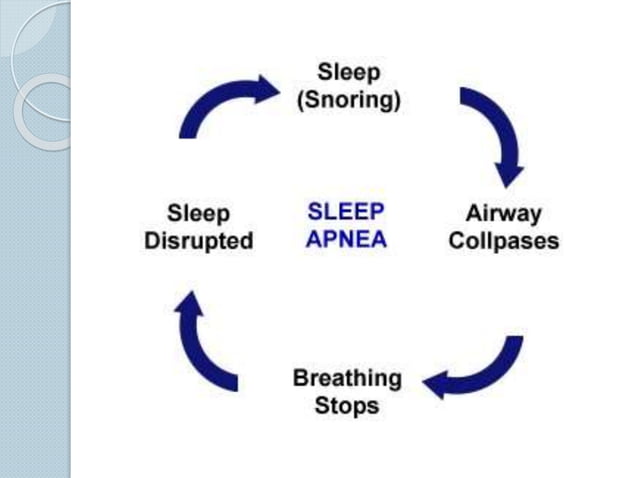 Etiology Of Obstructive sleep apnea | PPT
