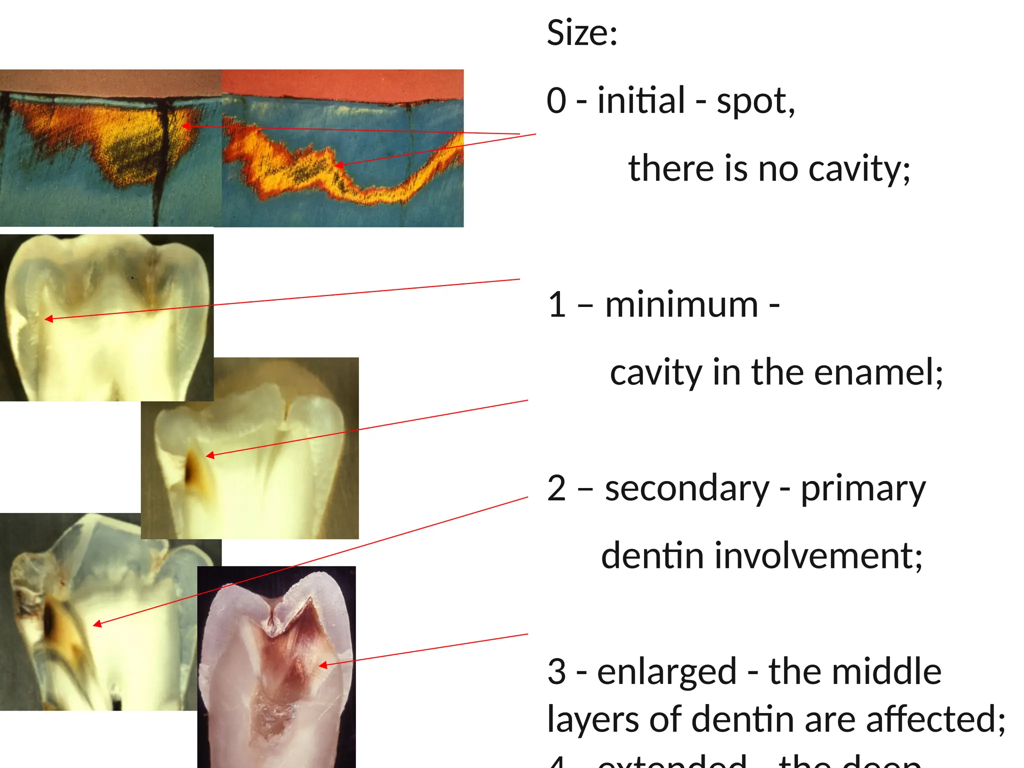 ETIOLOGY AND PATHOGENESIS OF DENTAL CARIES. CLASSIFICATION OF CARIES ...