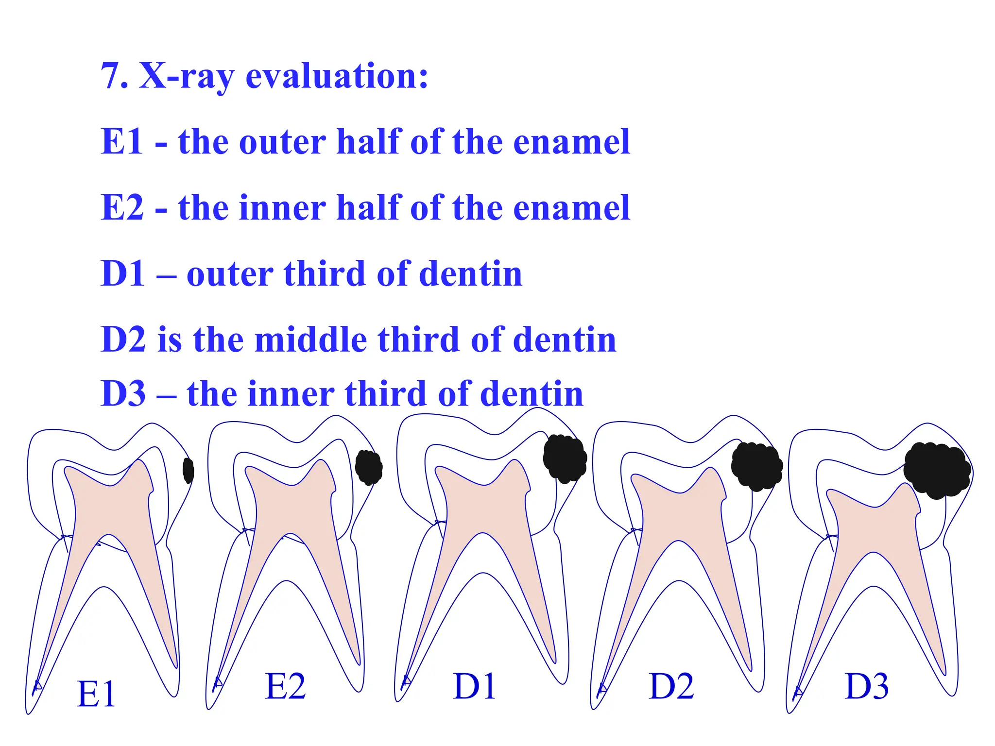 ETIOLOGY AND PATHOGENESIS OF DENTAL CARIES. CLASSIFICATION OF CARIES ...