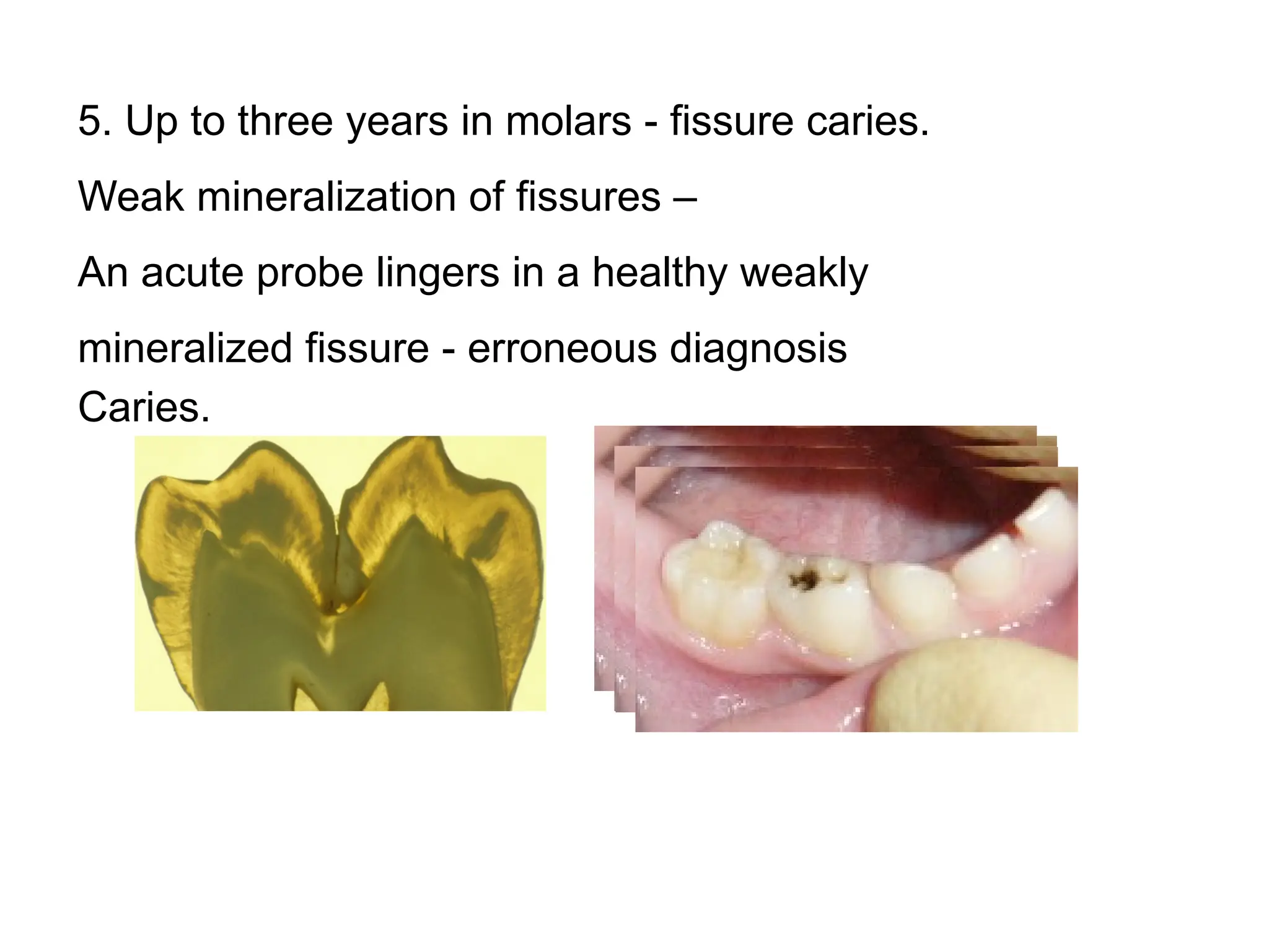 ETIOLOGY AND PATHOGENESIS OF DENTAL CARIES. CLASSIFICATION OF CARIES ...