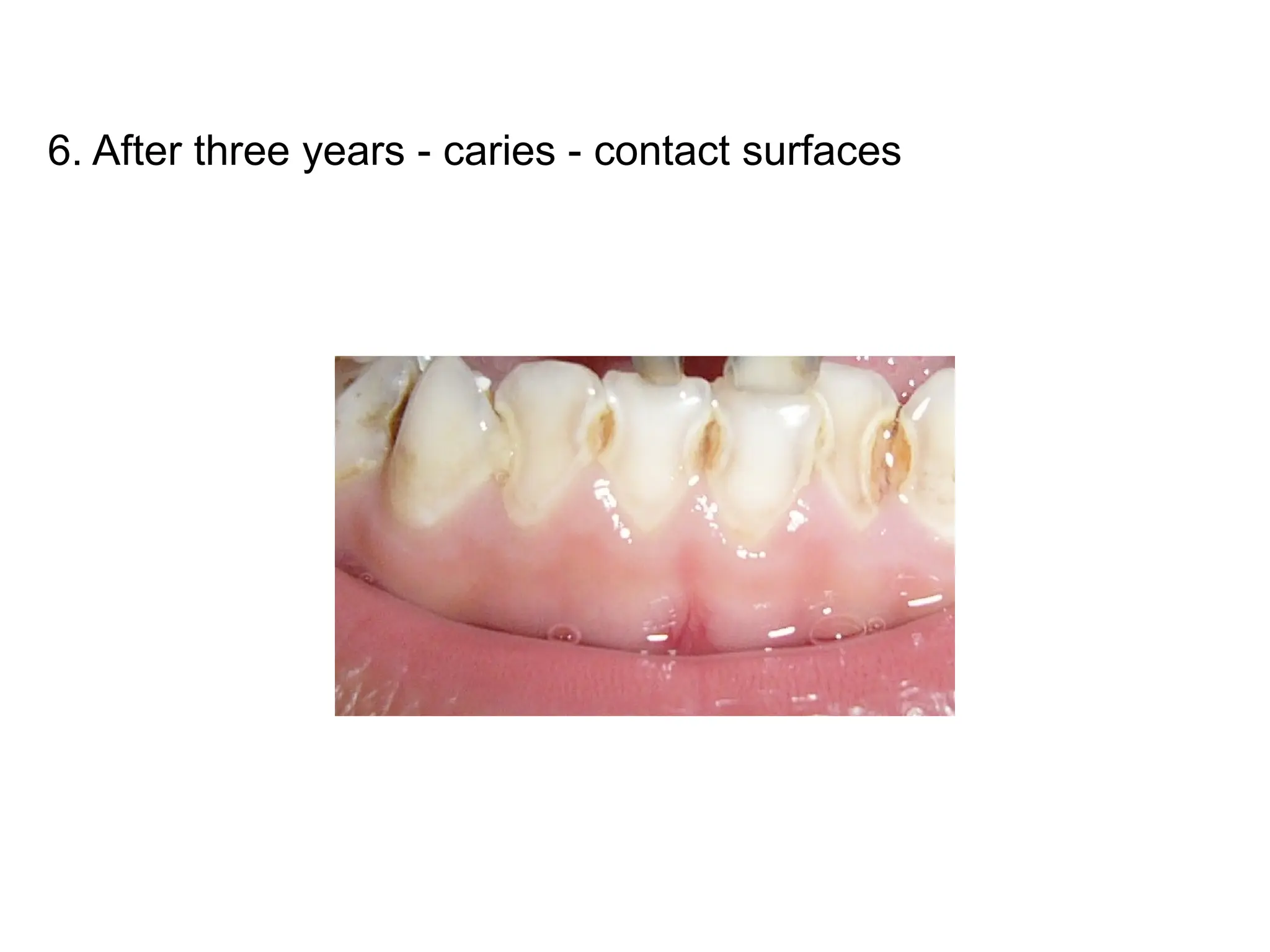 ETIOLOGY AND PATHOGENESIS OF DENTAL CARIES. CLASSIFICATION OF CARIES ...