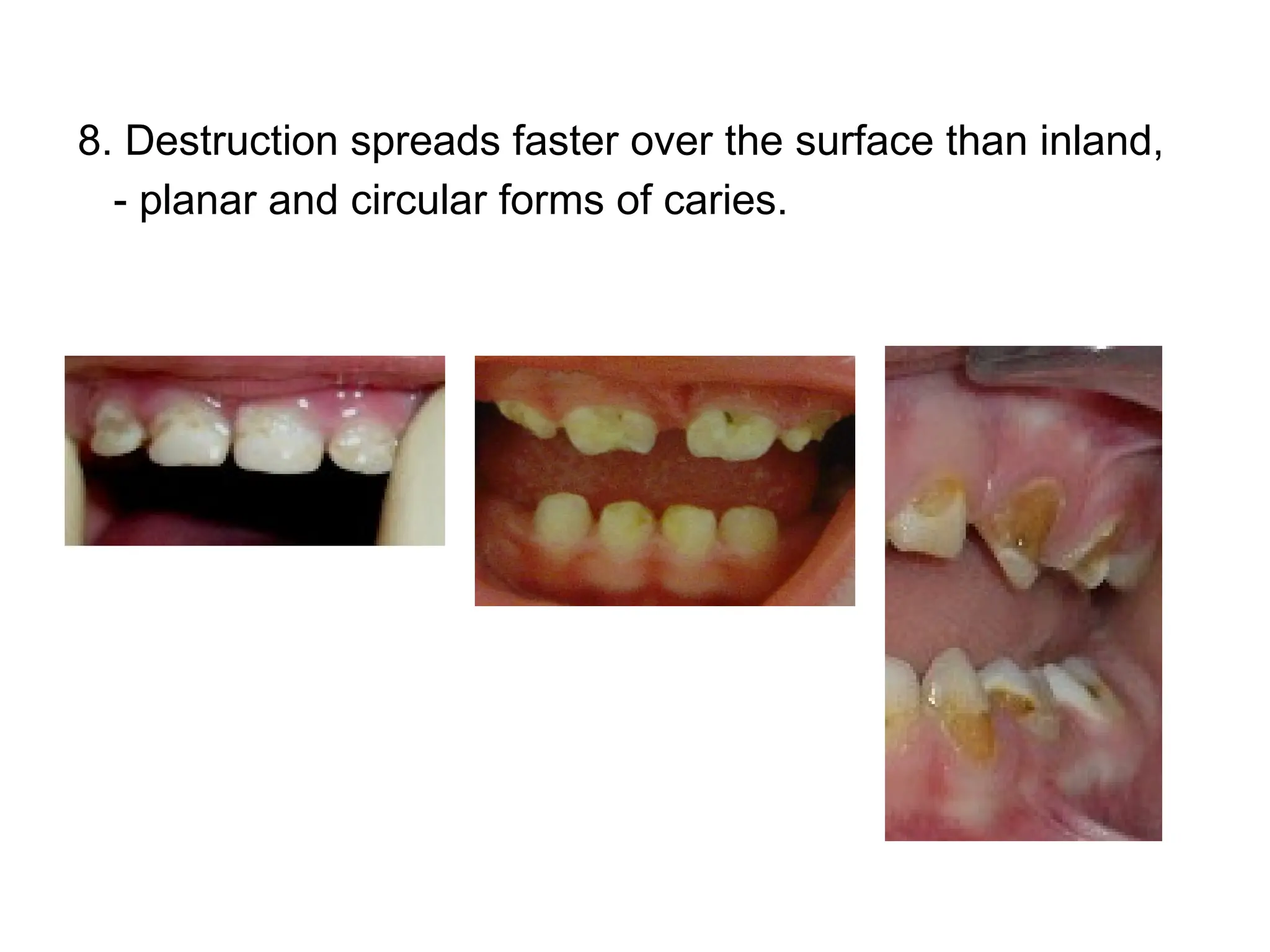 ETIOLOGY AND PATHOGENESIS OF DENTAL CARIES. CLASSIFICATION OF CARIES ...