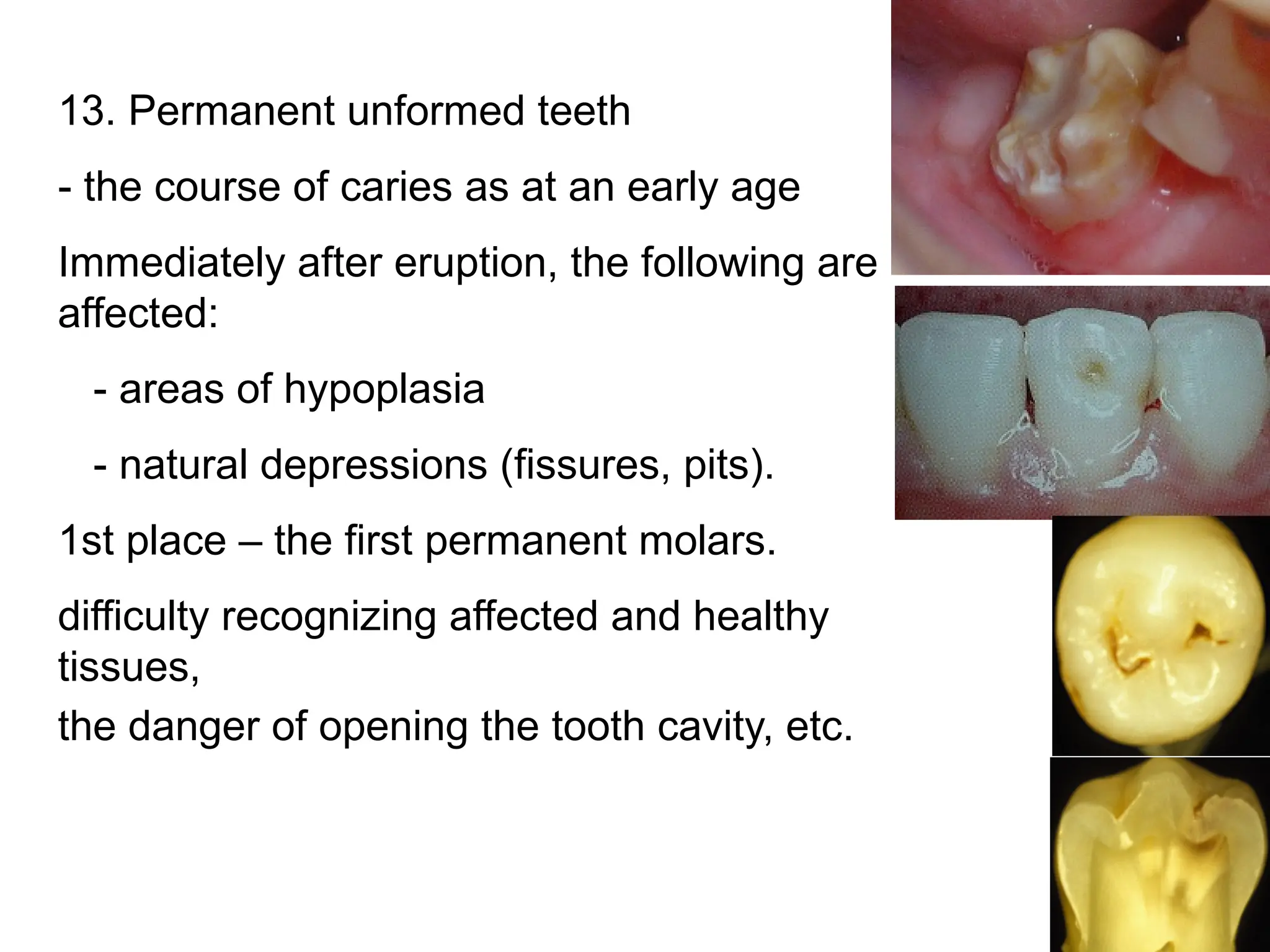 ETIOLOGY AND PATHOGENESIS OF DENTAL CARIES. CLASSIFICATION OF CARIES ...