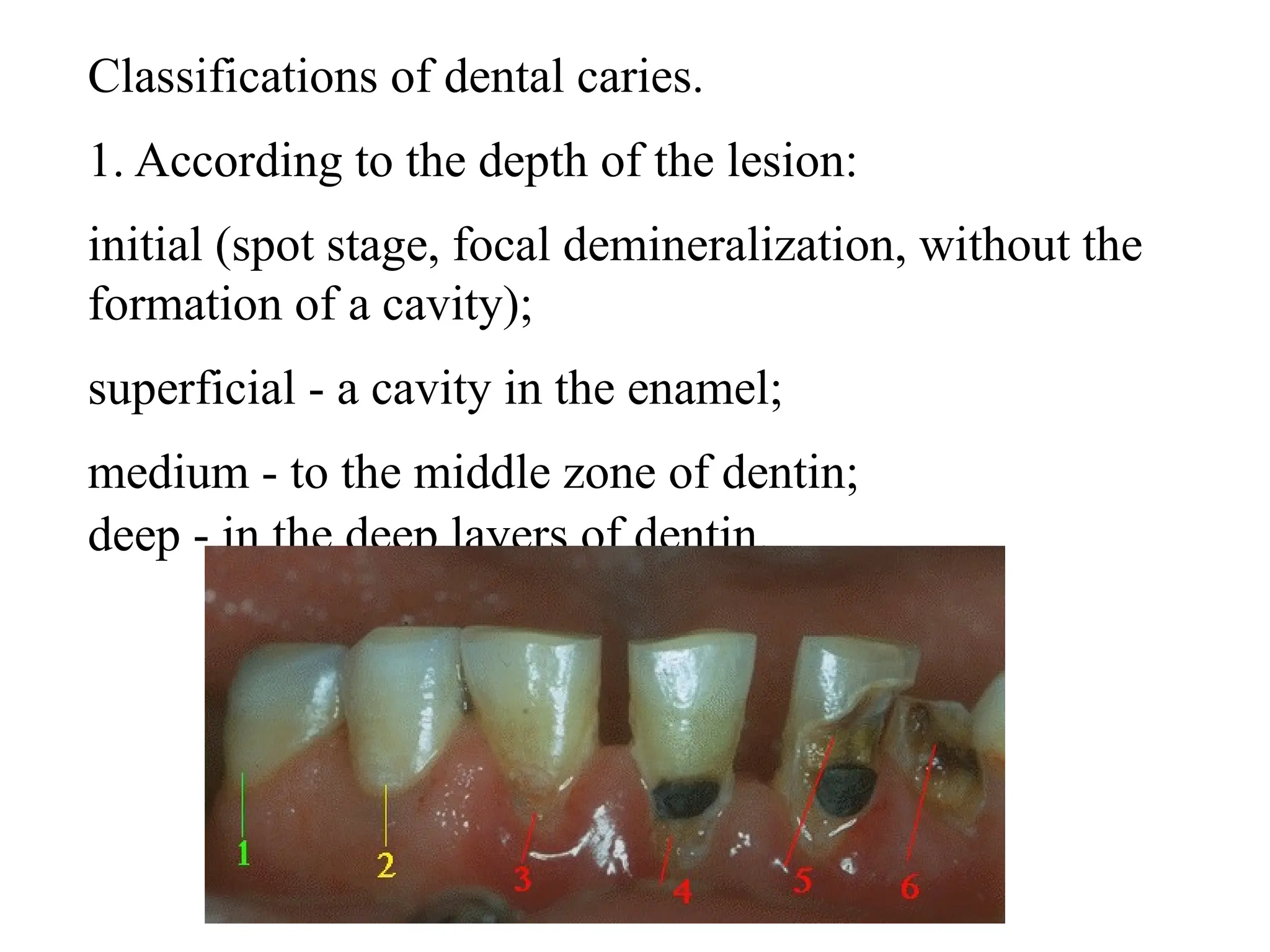 ETIOLOGY AND PATHOGENESIS OF DENTAL CARIES. CLASSIFICATION OF CARIES ...