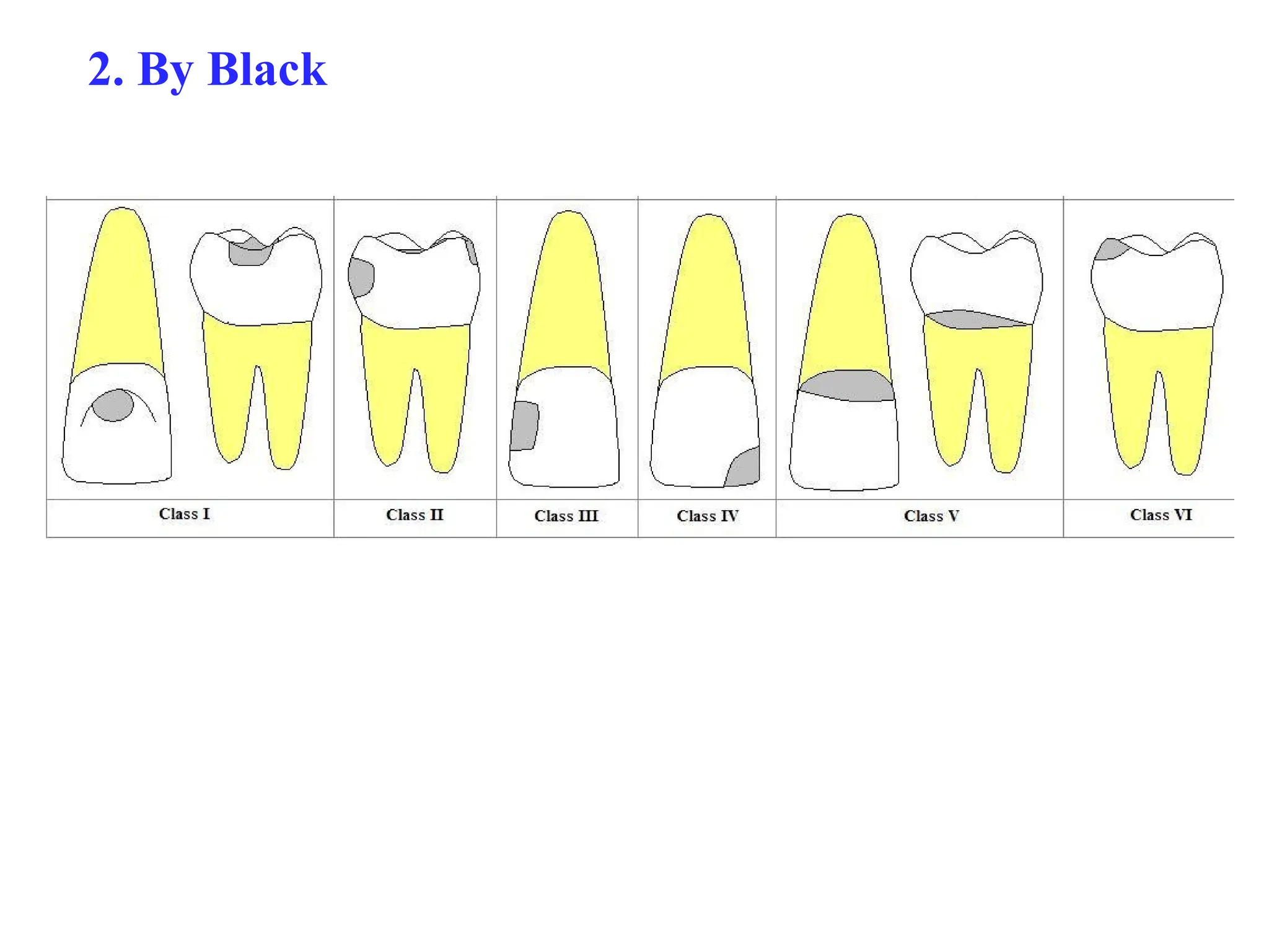 ETIOLOGY AND PATHOGENESIS OF DENTAL CARIES. CLASSIFICATION OF CARIES ...