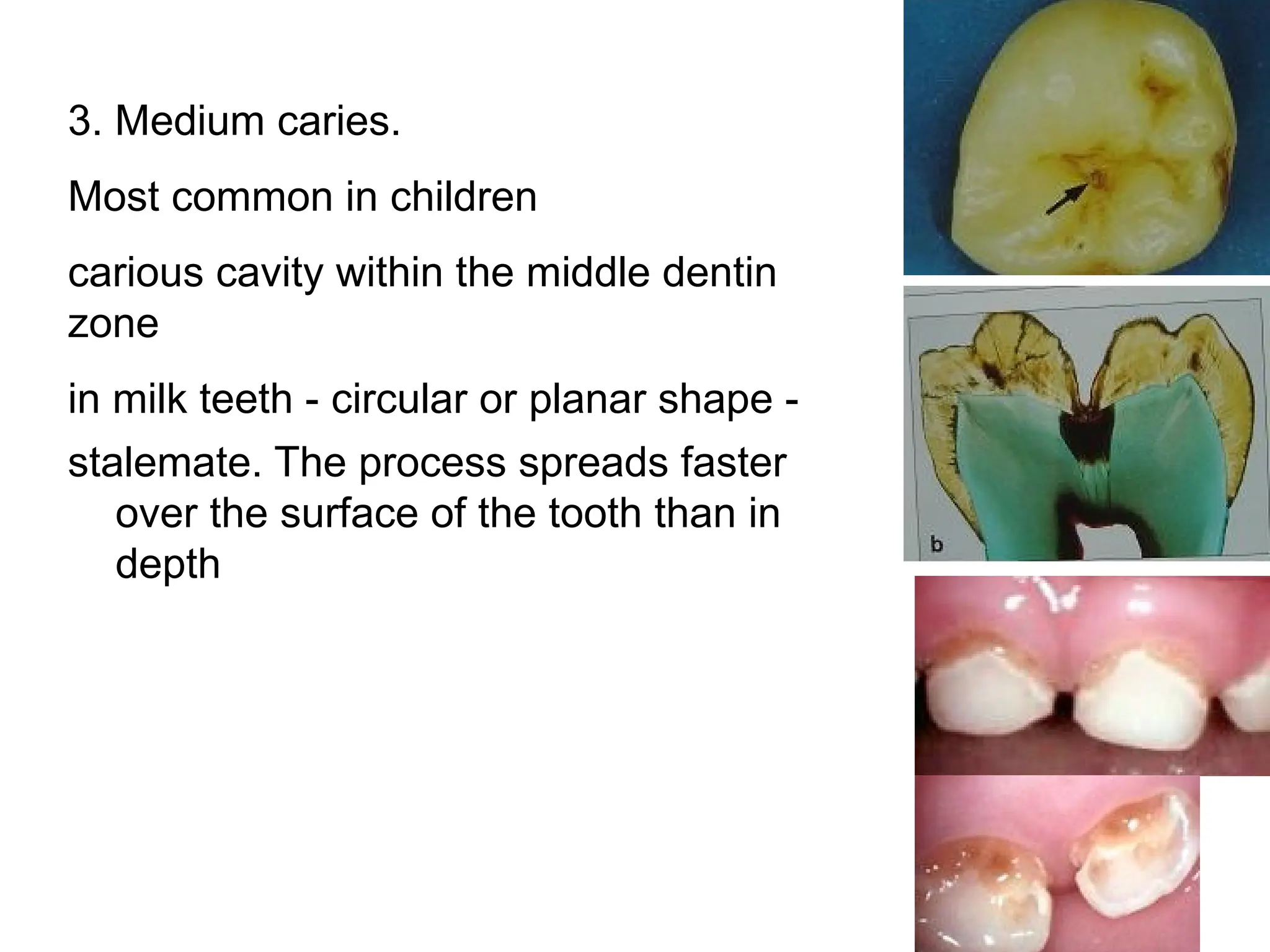 ETIOLOGY AND PATHOGENESIS OF DENTAL CARIES. CLASSIFICATION OF CARIES ...
