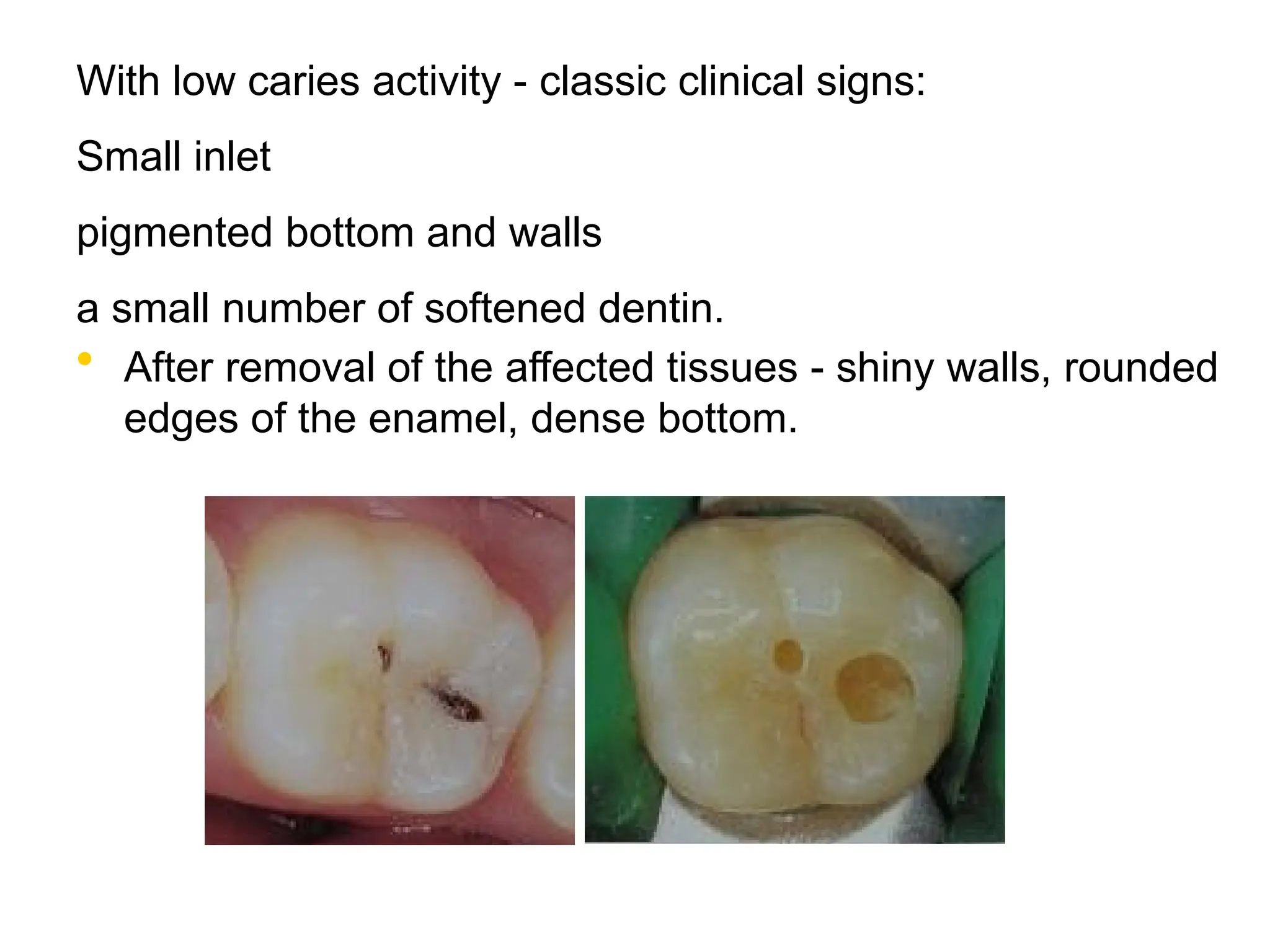ETIOLOGY AND PATHOGENESIS OF DENTAL CARIES. CLASSIFICATION OF CARIES ...