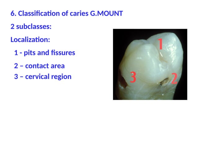 ETIOLOGY AND PATHOGENESIS OF DENTAL CARIES. CLASSIFICATION OF CARIES ...