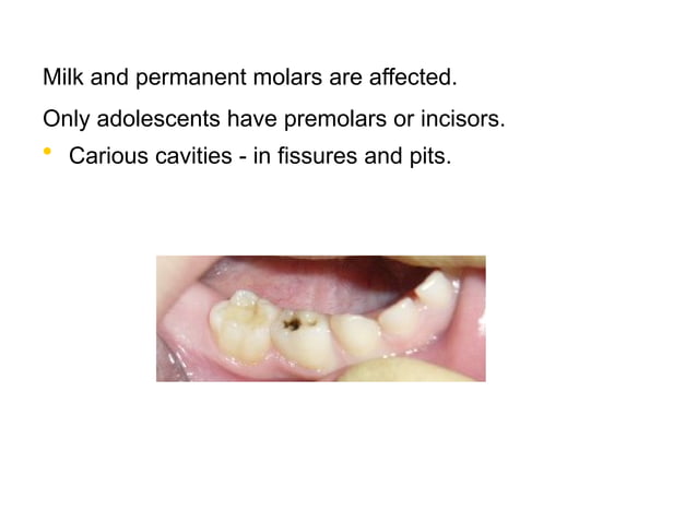 ETIOLOGY AND PATHOGENESIS OF DENTAL CARIES. CLASSIFICATION OF CARIES ...