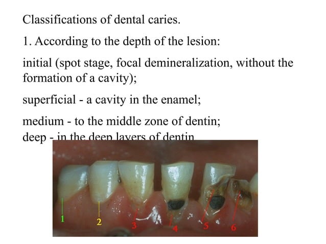 ETIOLOGY AND PATHOGENESIS OF DENTAL CARIES. CLASSIFICATION OF CARIES ...