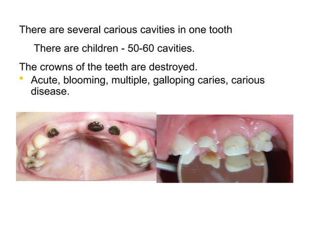 ETIOLOGY AND PATHOGENESIS OF DENTAL CARIES. CLASSIFICATION OF CARIES ...