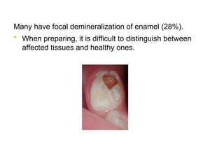 ETIOLOGY AND PATHOGENESIS OF DENTAL CARIES. CLASSIFICATION OF CARIES ...