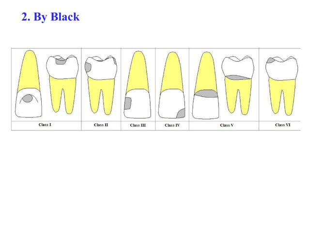ETIOLOGY AND PATHOGENESIS OF DENTAL CARIES. CLASSIFICATION OF CARIES ...