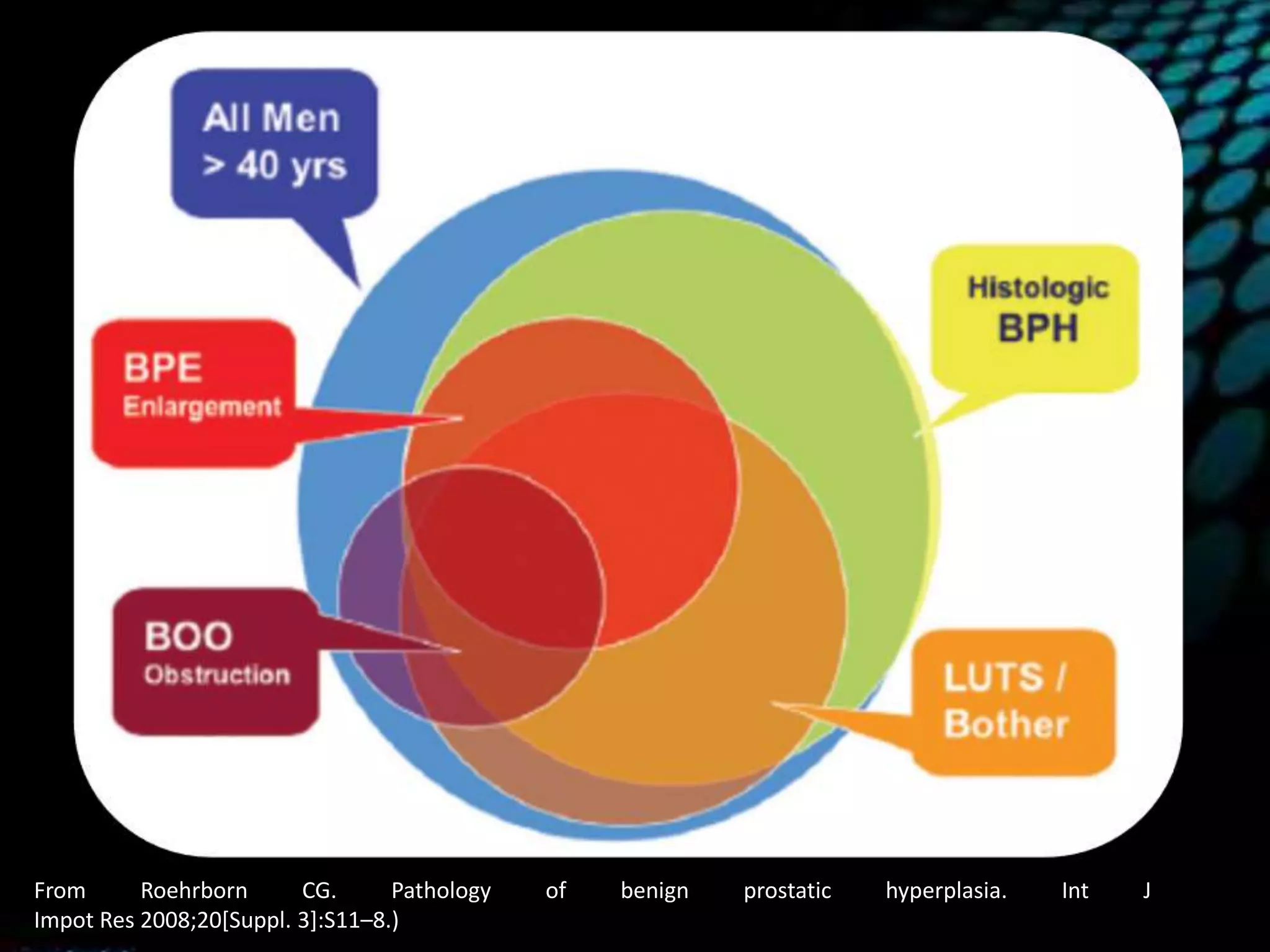 Etiology and pathophysiology of bph | PPTX