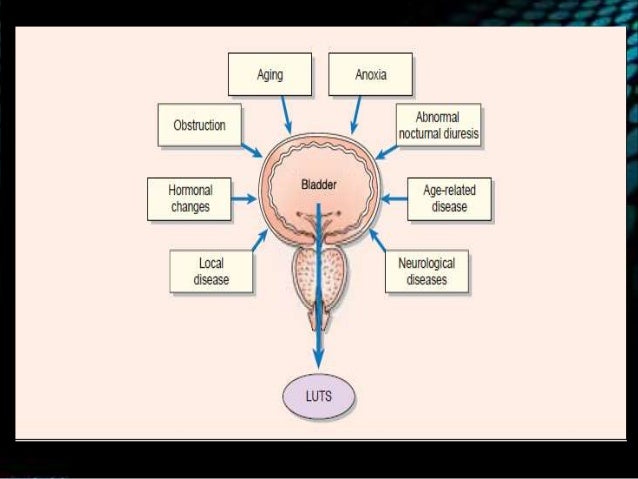 Benign Prostatic Hyperplasia Pathophysiology Diagram