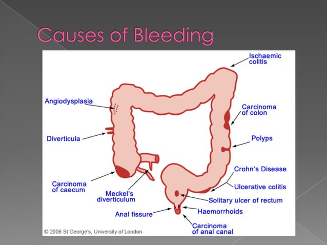 Etiology Bleeding Per Rectum | PPTX