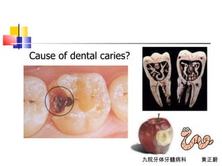 Etiology of dental caries | PPT