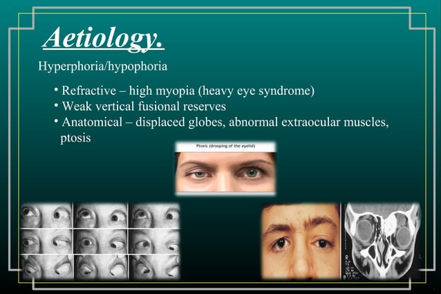 Etiology of heterophoria and heterotropia | PPT
