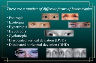 Etiology of heterophoria and heterotropia | PPT