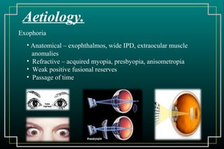 Etiology of heterophoria and heterotropia | PPT