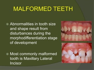 Etiology of malocclusion | PPTX