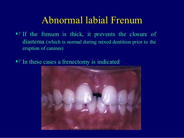 Torn Labial Frenulum