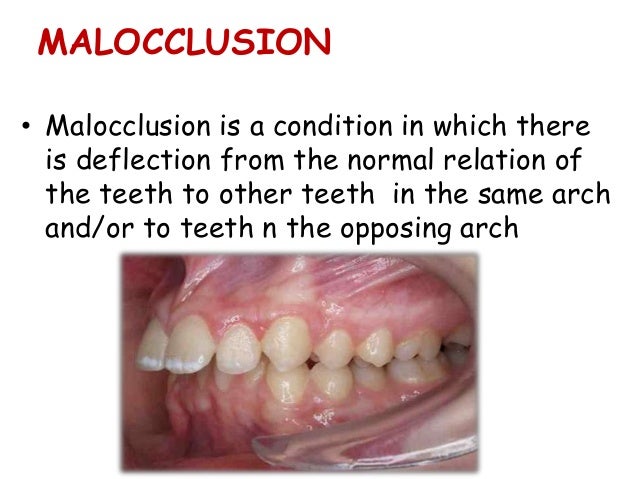 Etiology of malocclusion