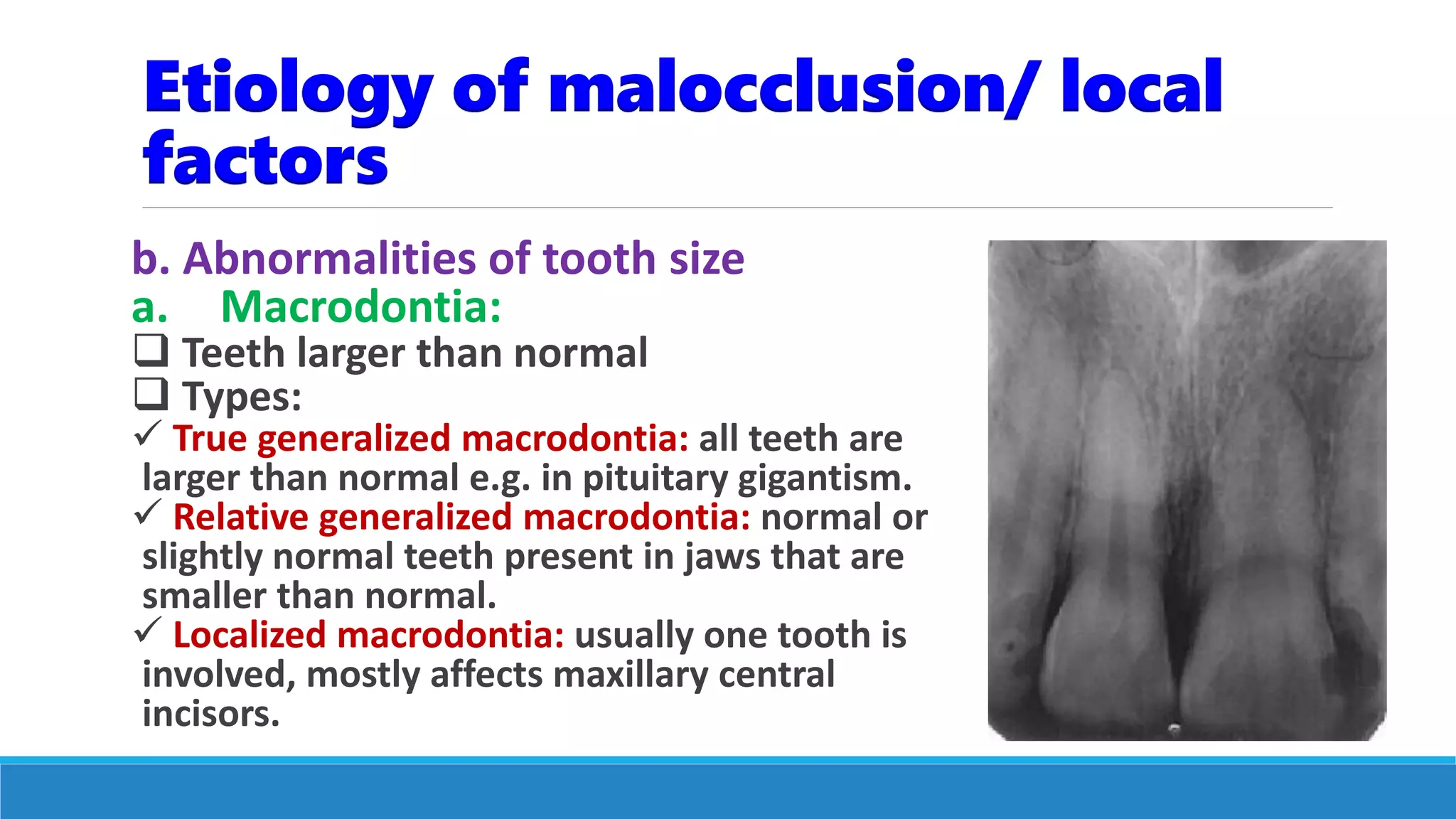 Etiology of malocclusion | PPTX