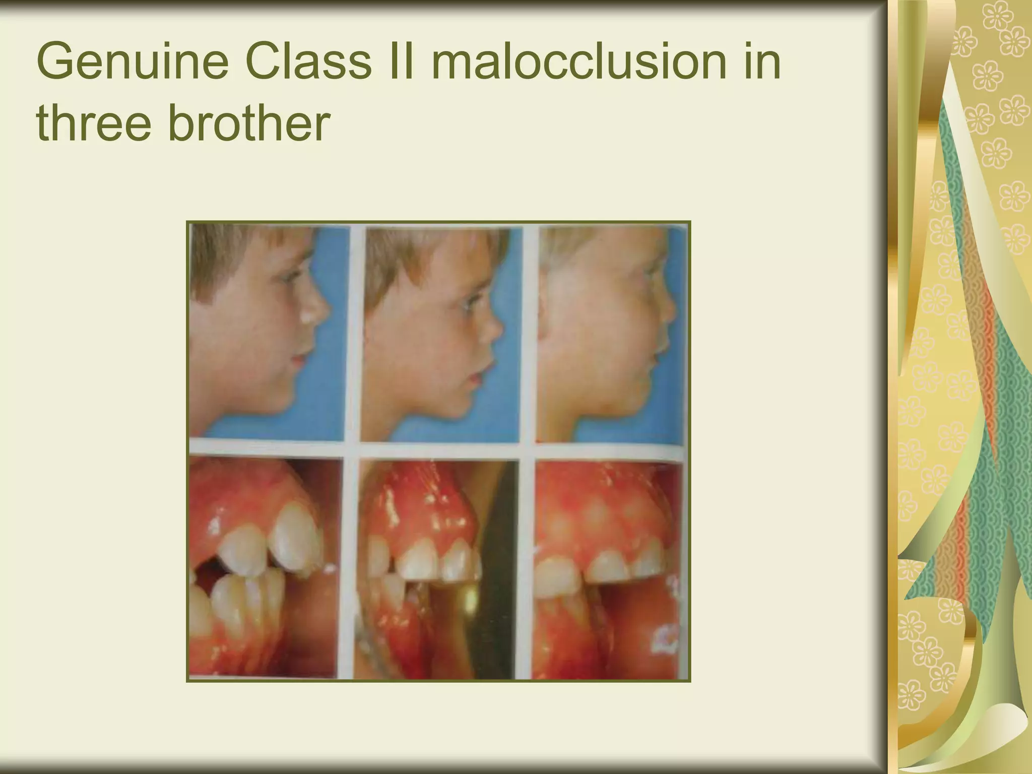 Etiology of malocclusion general factors | PPT