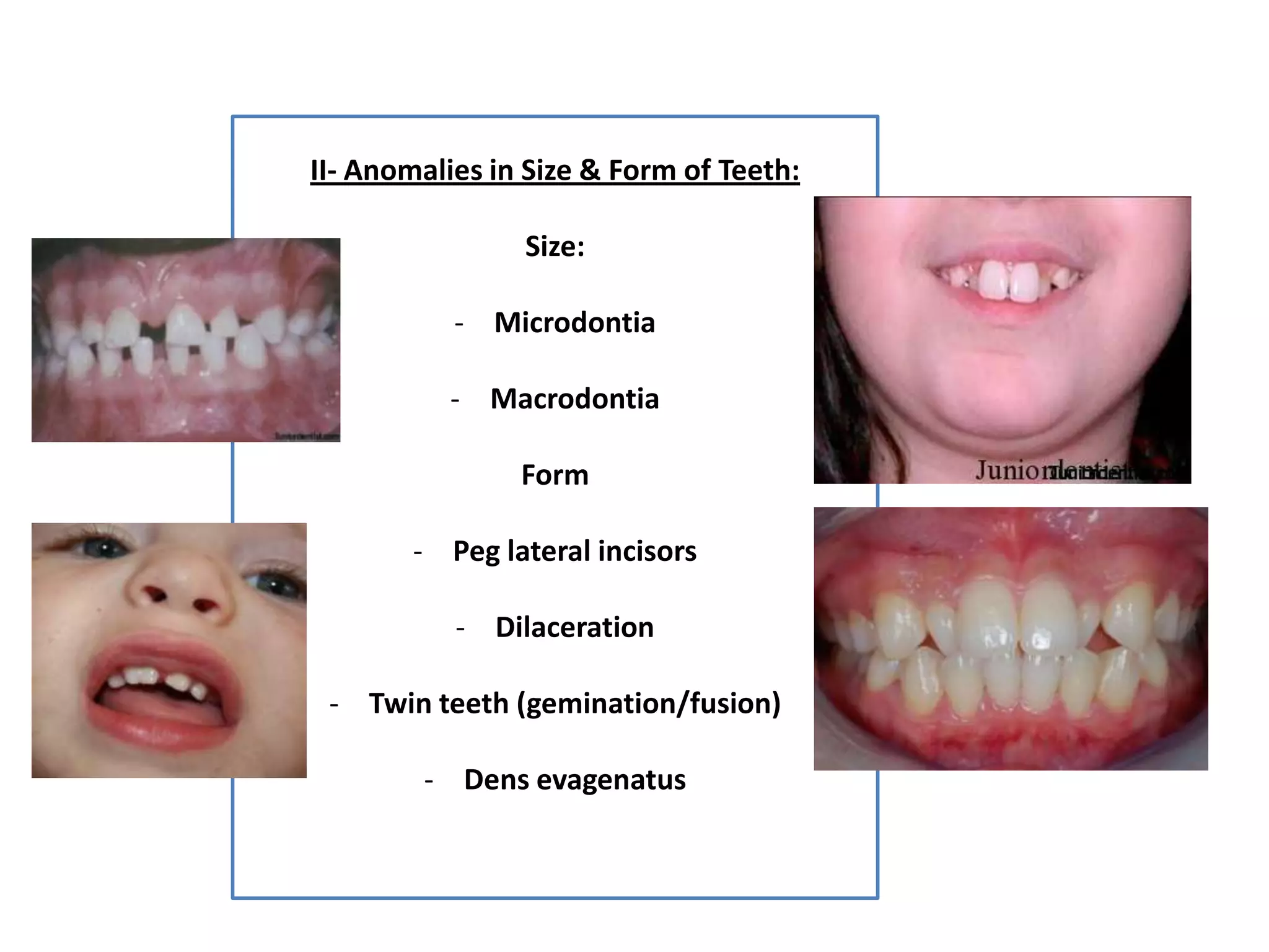 Local Factors_Etiology of Malocclusion - Dr. Nabil Al-Zubair | PDF