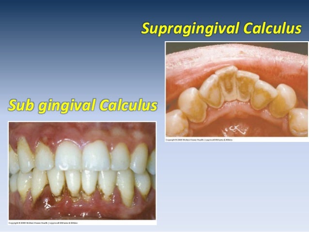 Etiology of periodontal disease