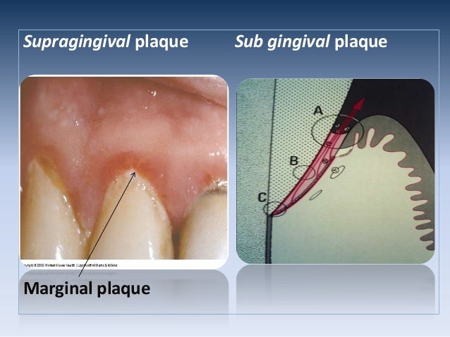 Etiology of periodontal disease