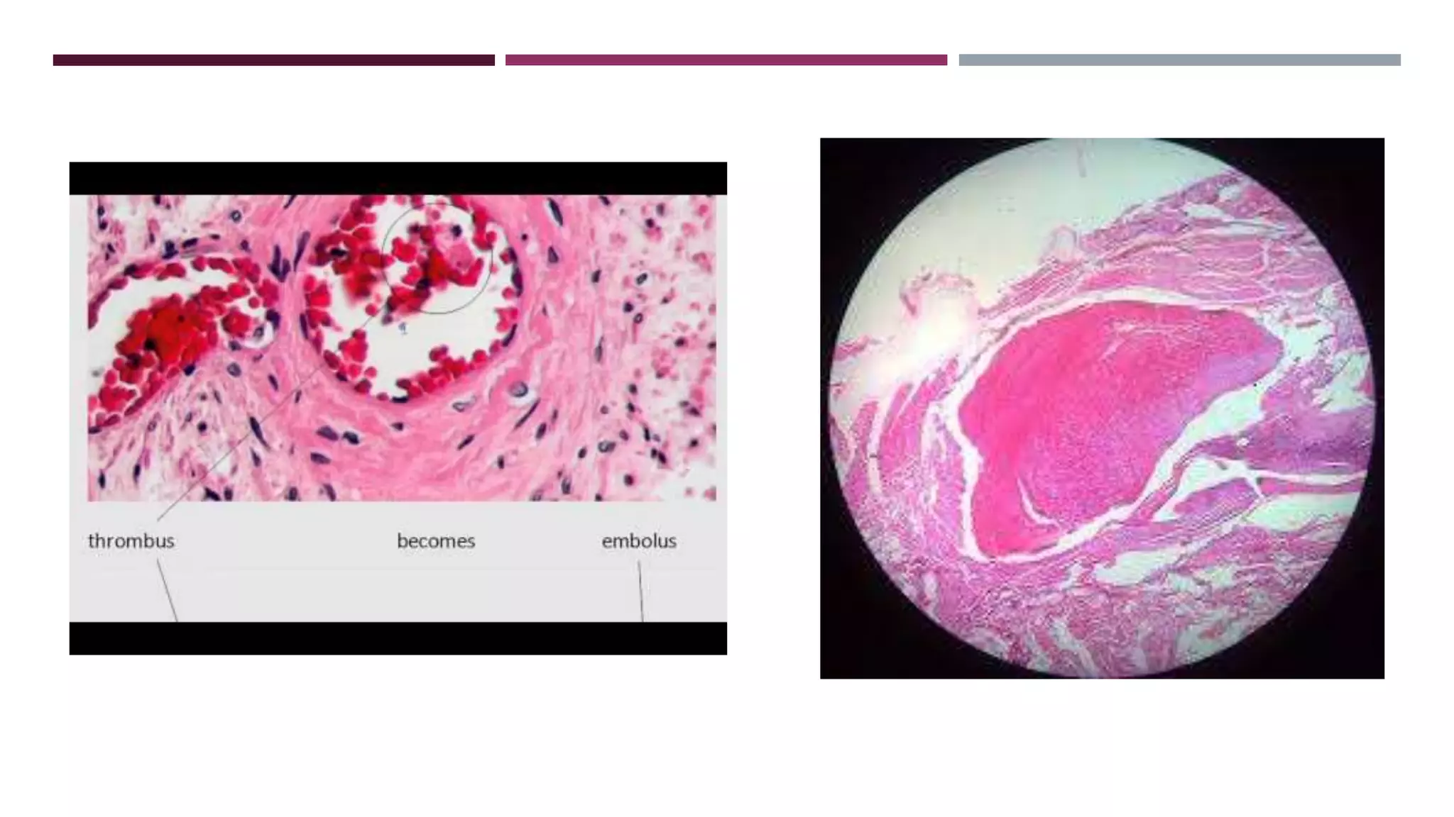 Etiology, pathogenesis & Morphology of thrombosis.pptx