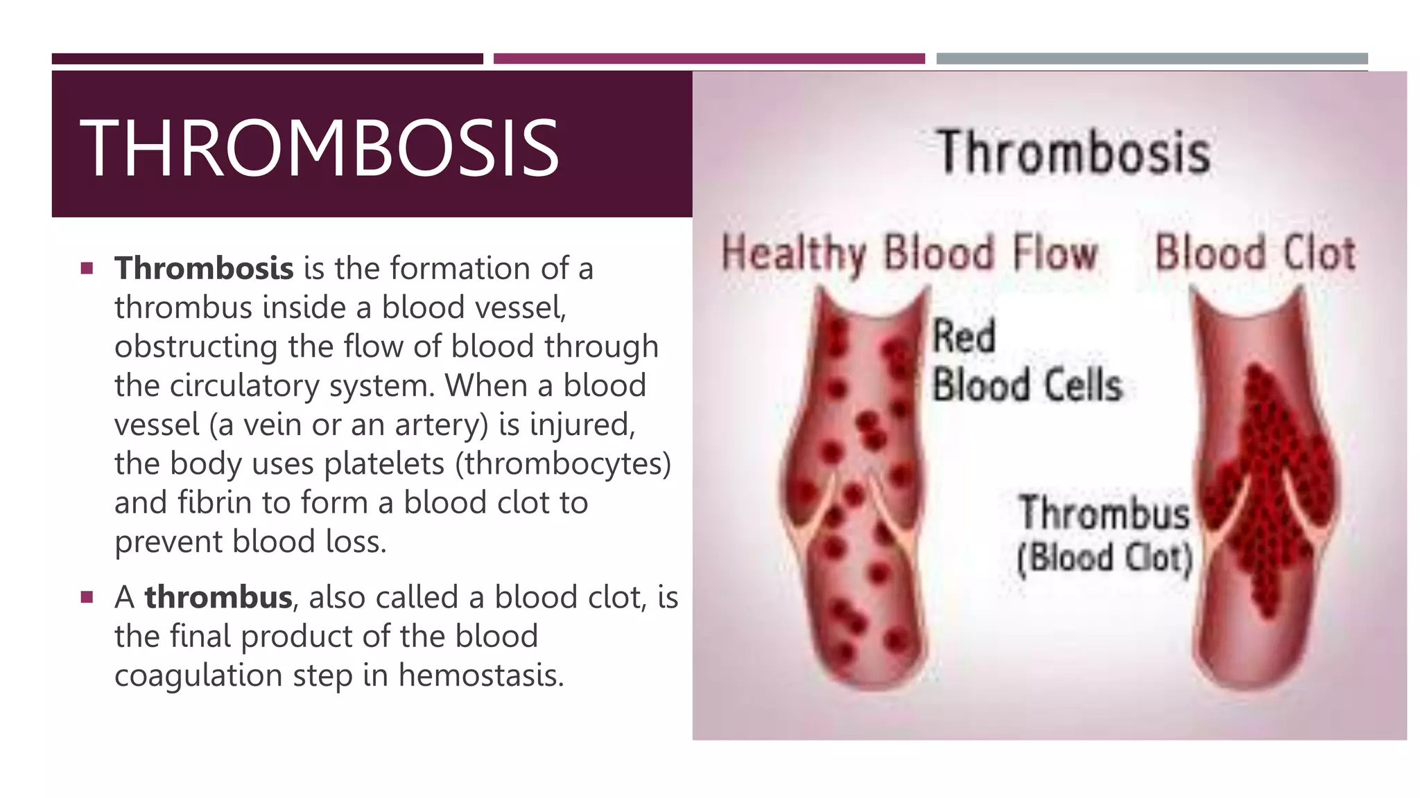 Etiology, pathogenesis & Morphology of thrombosis.pptx