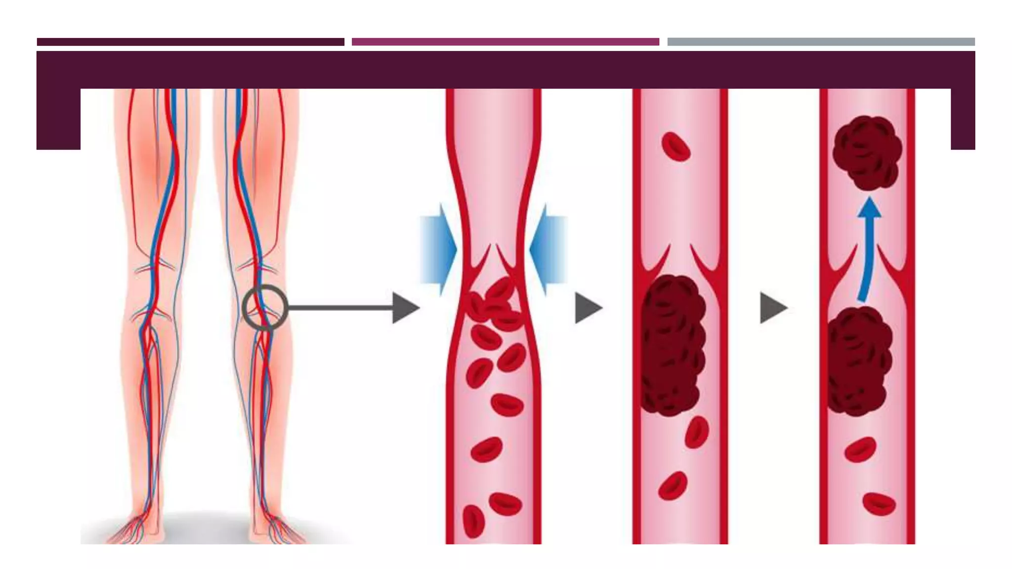 Etiology, pathogenesis & Morphology of thrombosis.pptx