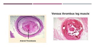Etiology, pathogenesis & Morphology of thrombosis.pptx