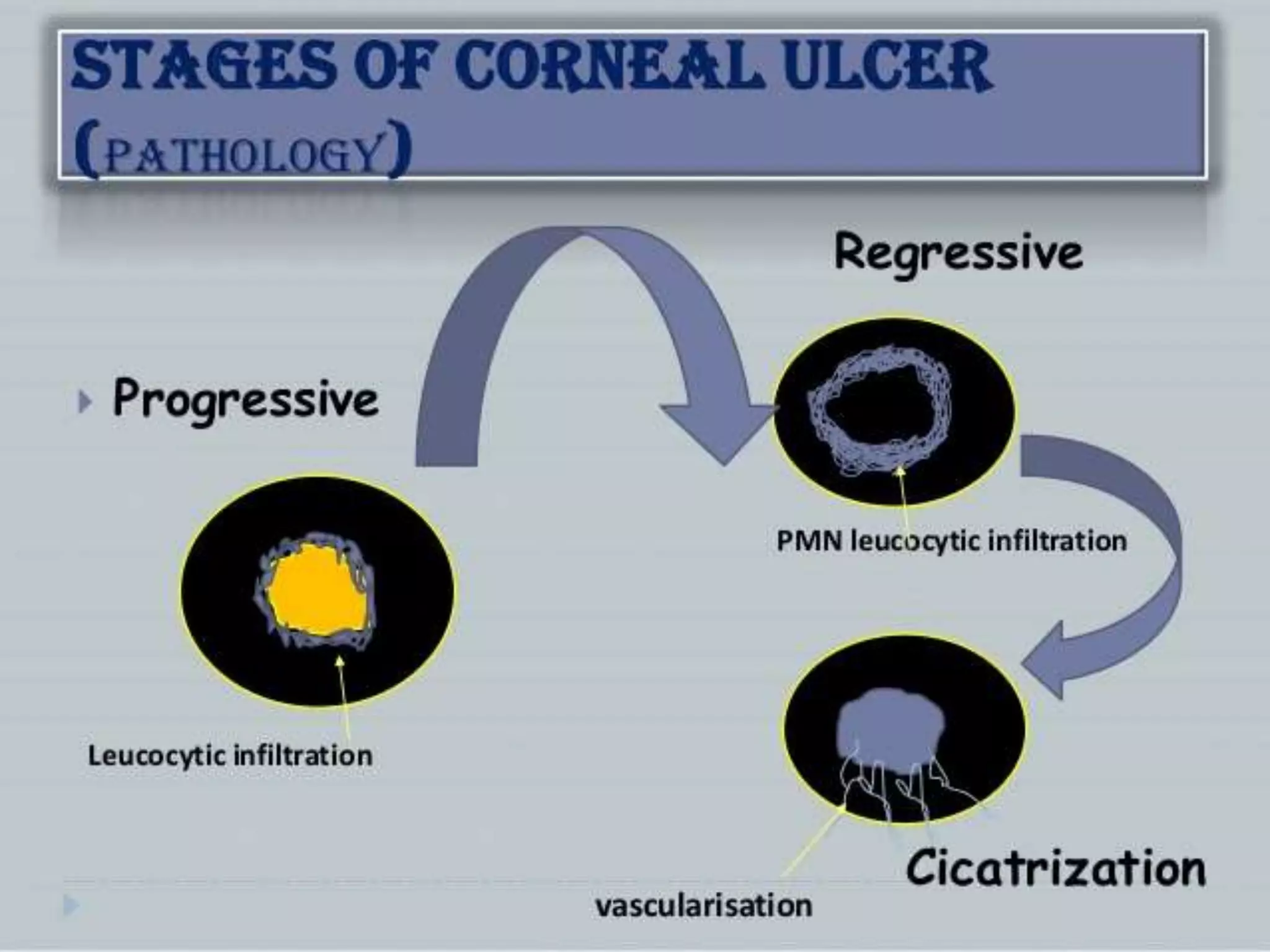 ETIOLOGY, PATHOLOGY AND PATHOGENESIS OF CORNEAL ULCER | PPTX