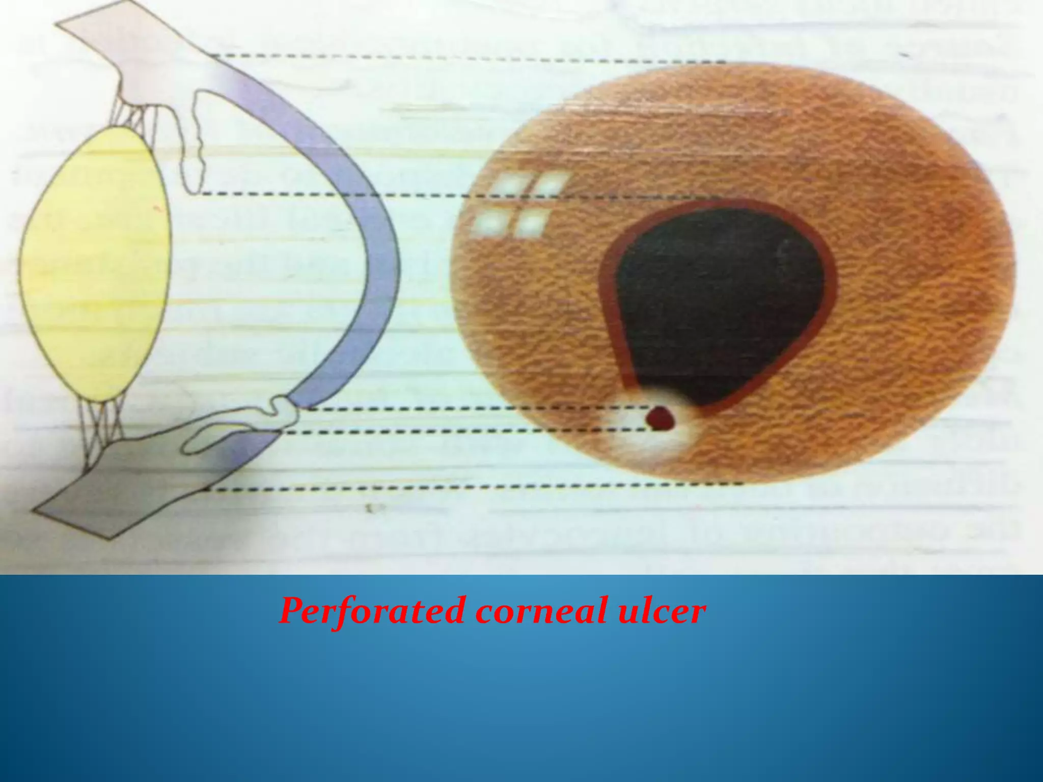 ETIOLOGY, PATHOLOGY AND PATHOGENESIS OF CORNEAL ULCER | PPTX