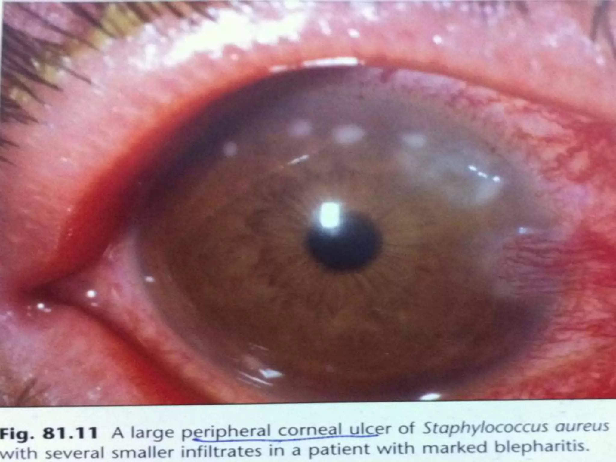 ETIOLOGY, PATHOLOGY AND PATHOGENESIS OF CORNEAL ULCER | PPTX