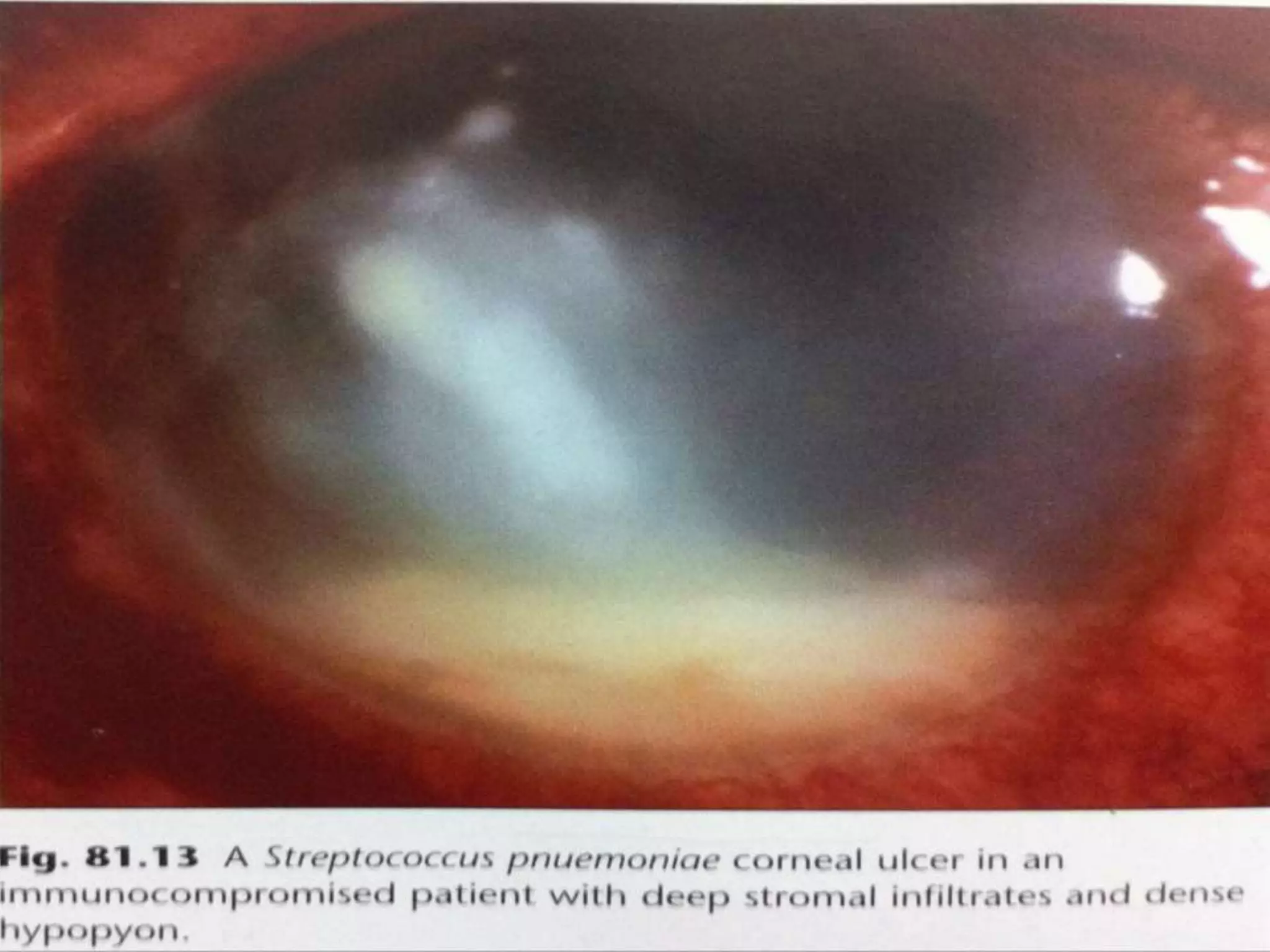 ETIOLOGY, PATHOLOGY AND PATHOGENESIS OF CORNEAL ULCER | PPTX